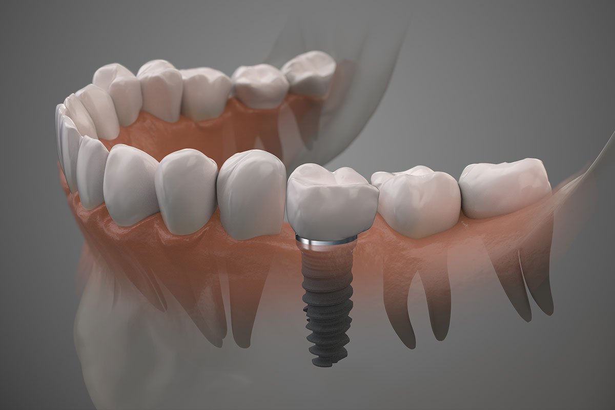 Οδοντικά Εμφυτεύματα | Maragkos Dental Clinic