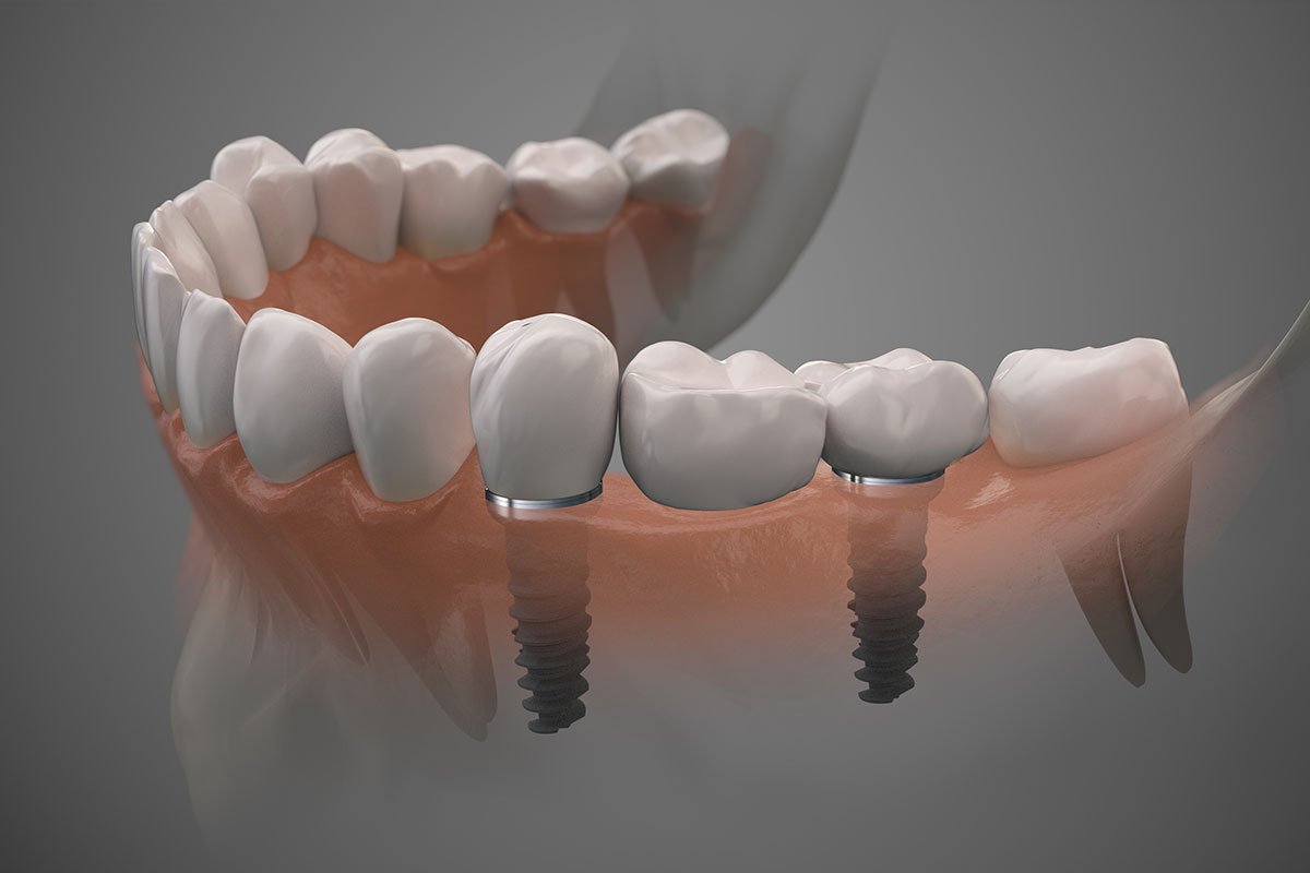 Οδοντικά Εμφυτεύματα | Maragkos Dental Clinic